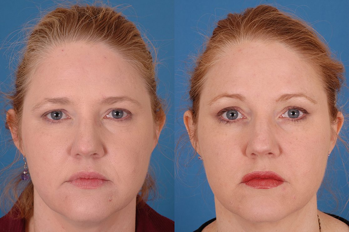 Brow Lift Before And After Photos Dr Benjamin Bassichis